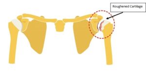 What’s Wrong with my Shoulder? – Stiff and Painful Shoulder (MSK ...